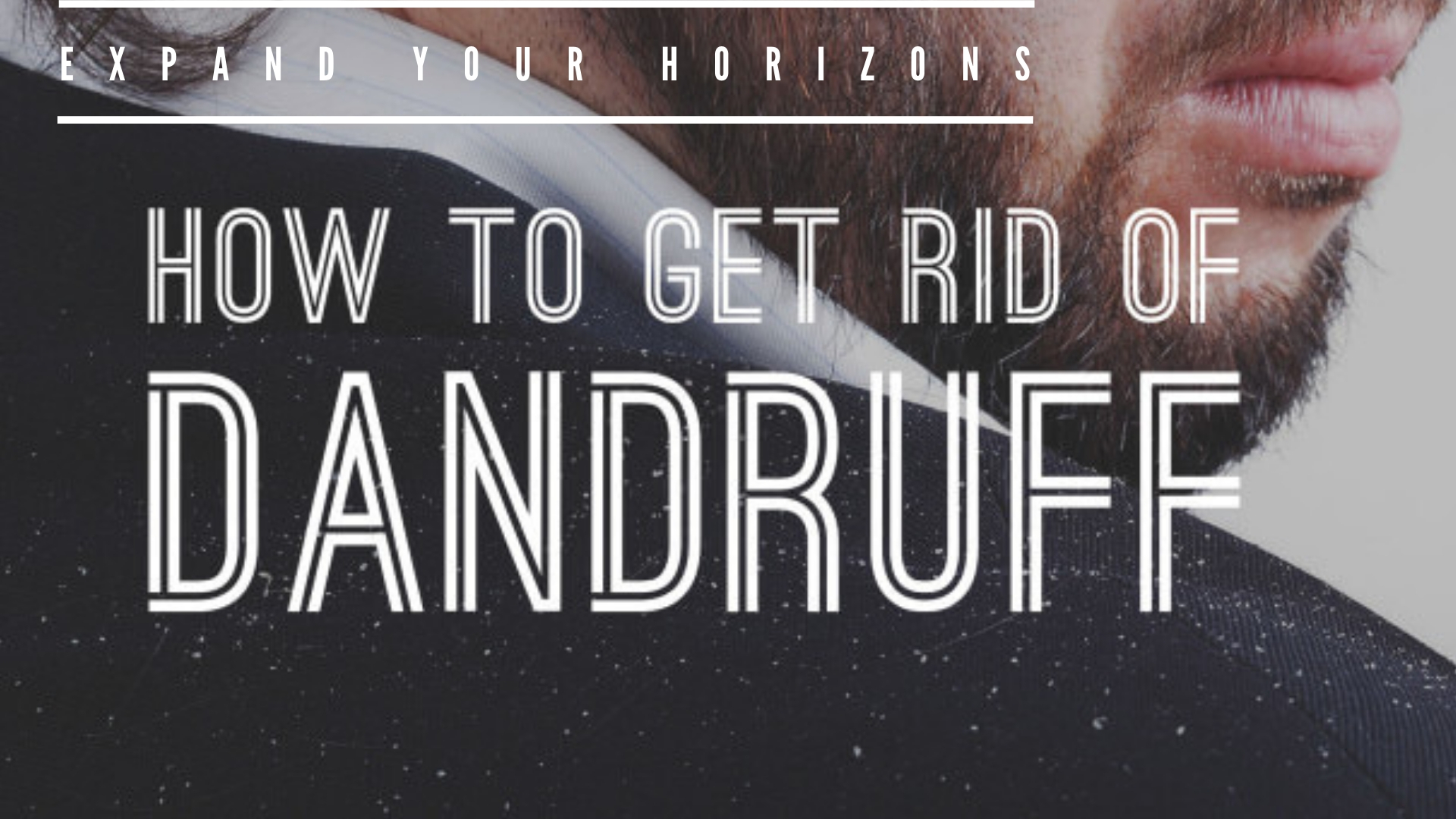 Dandruff: causes and treatment, symptoms. How to get rid of dandruff?